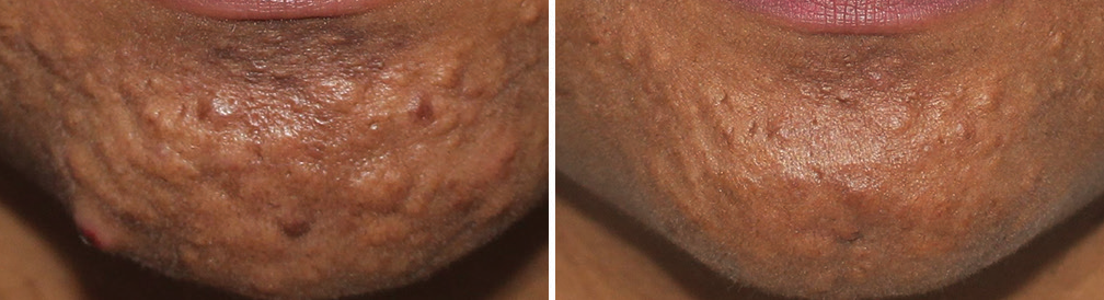 Chin Acne Scars